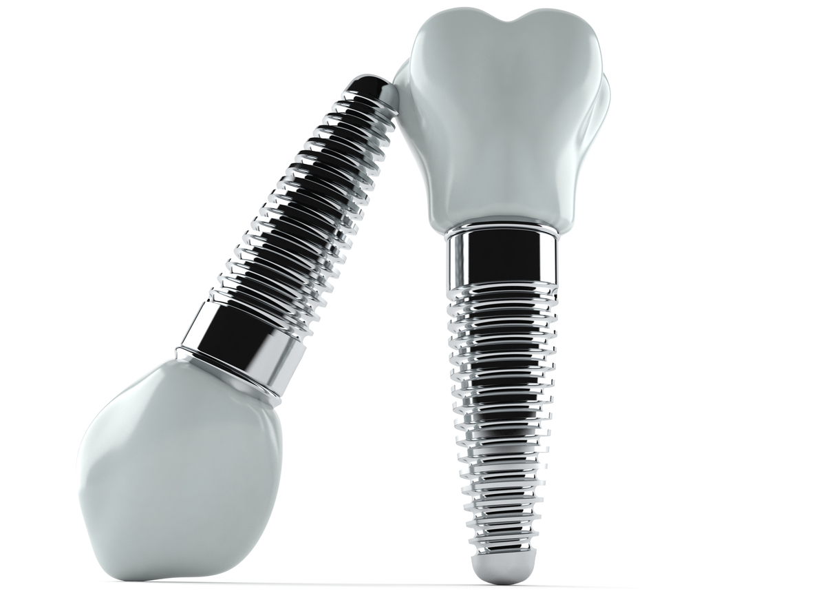 Get A Long-Lasting, Natural-Looking Dental Implant in San Antonio ...